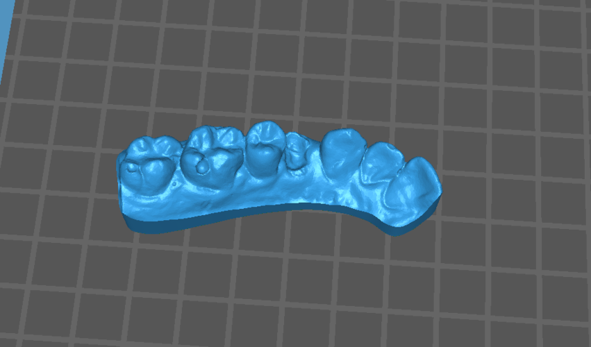 3D Printed 2-Unit Dental Bridge Design by Joseph0 | Pinshape