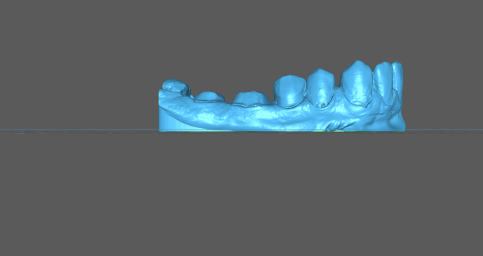3D Printed 2-Unit Dental Bridge Design by Joseph0 | Pinshape