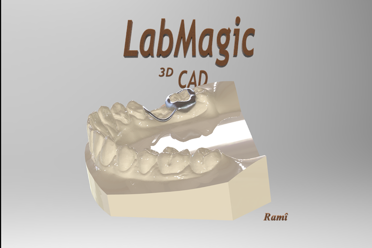 3D Printed Digital Space Maintainer Appliance (Dental) by LabMagic 3D ...
